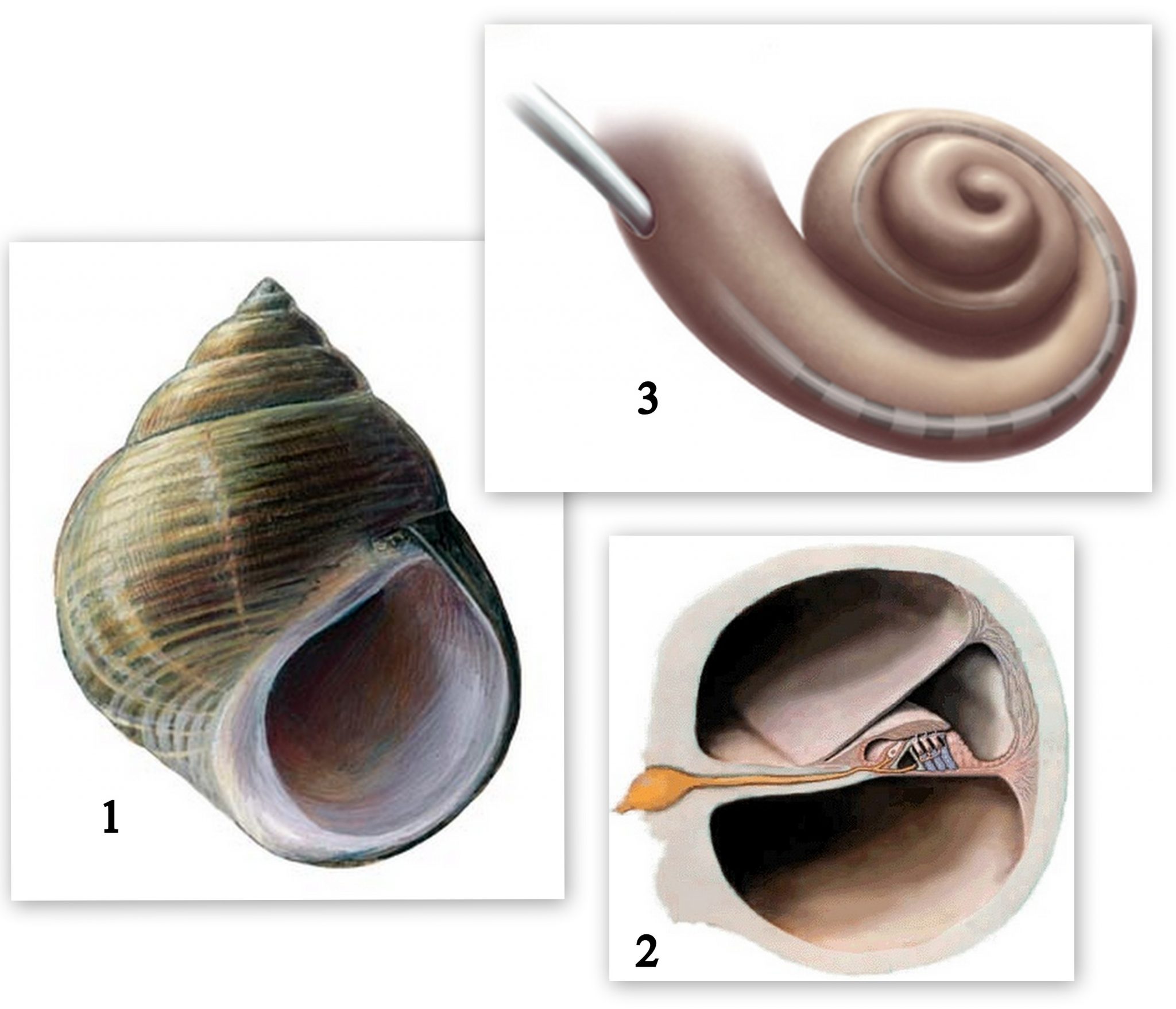 As Vantagens E Desvantagens Do IMPLANTE COCLEAR 2024